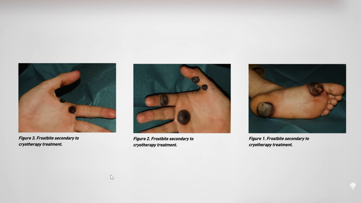 Should We Remove Warts with Duct Tape? - Amazing Health Advances