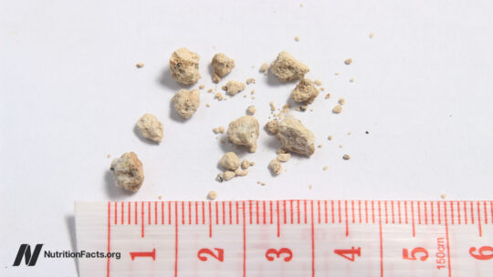 High Oxalate Greens and Kidney Stones