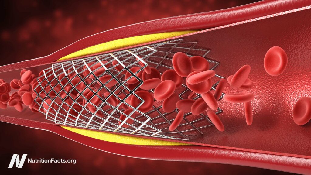 The Truth About Heart Stents