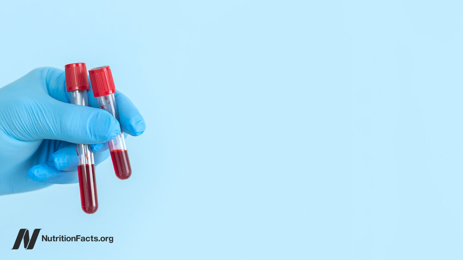 How to Treat High Lp(a), an Atherosclerosis Risk Factor