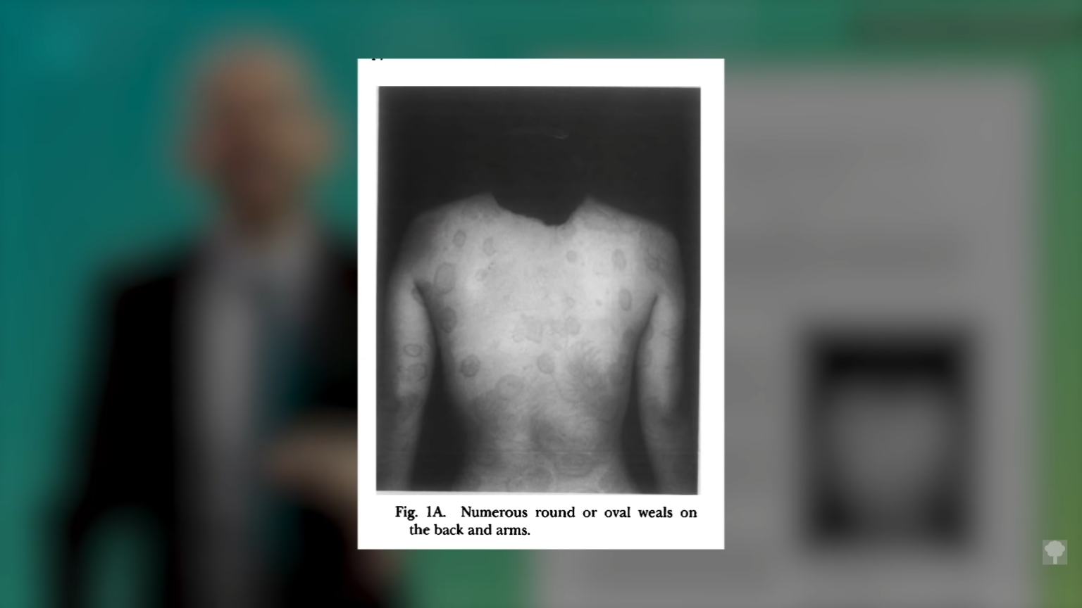 Does Fasting Help Autoimmune Diseases?