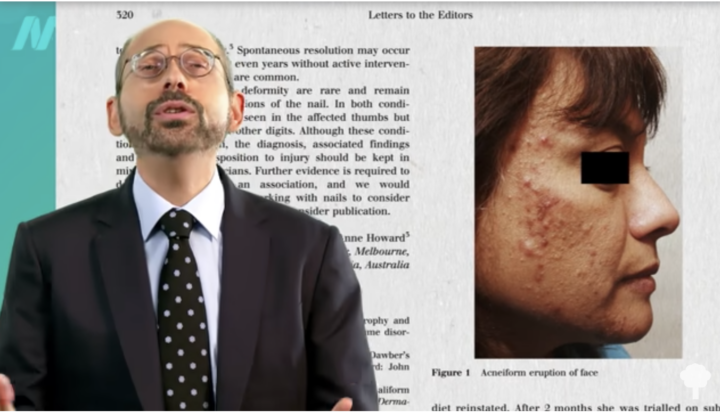 Acne and Vitamin B12